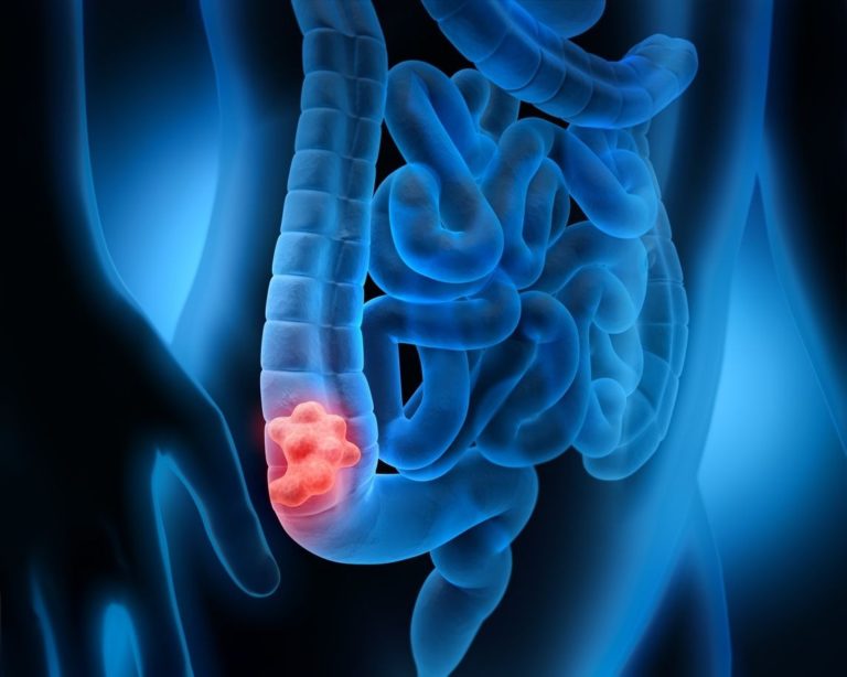 Polype intestinal : quel traitement naturel