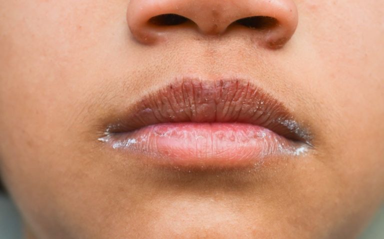 Stress et bouche sèche : quelles solutions Stress et bouche sèche : quelles solutions