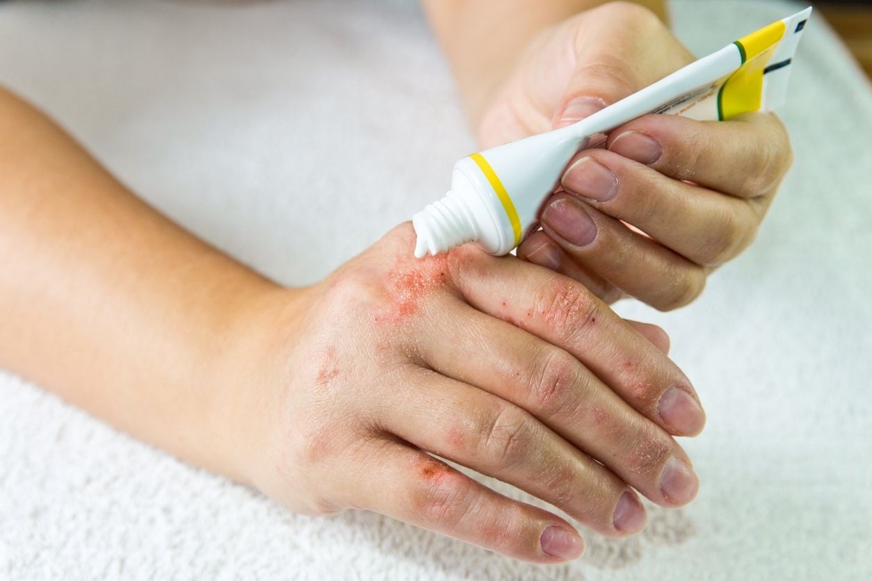 Stress et eczéma : comment soulager les problèmes de peau